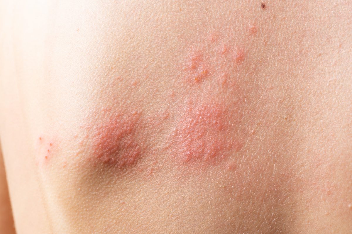 ¿Qué es la dermatitis atópica? | DermaPeople